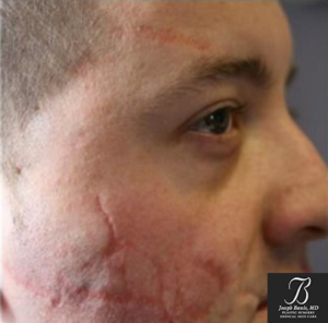 DEKA DOT | Prescott Plastic Surgery and Med Spa